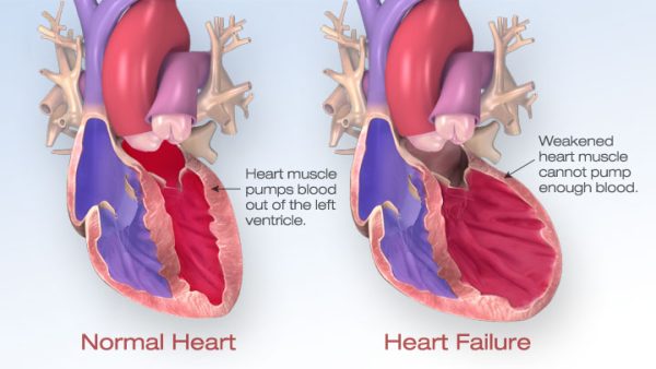 Cardiovascular Institute Offers Heart Failure Clinic | Cardiovascular ...