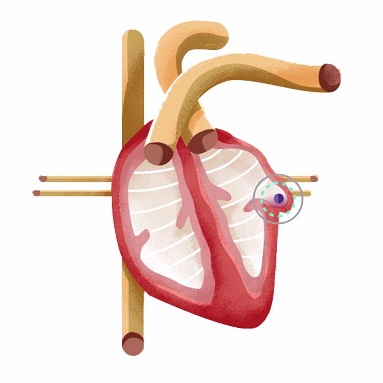 WATCHMAN Procedure • Cardiovascular Institute